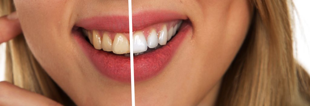 TINCIONES DENTALES – World's Hygienist
