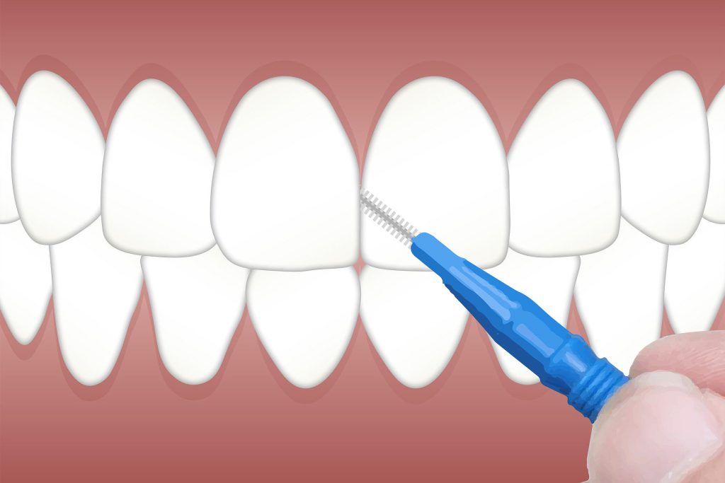 LA LIMPIEZA INTERPROXIMAL NUESTRO GRAN ALIADO – World's Hygienist