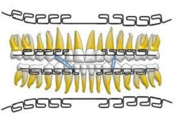 LOS ELASTICOS INTERMAXILARES – World's Hygienist