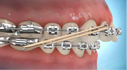 LOS ELASTICOS INTERMAXILARES – World's Hygienist