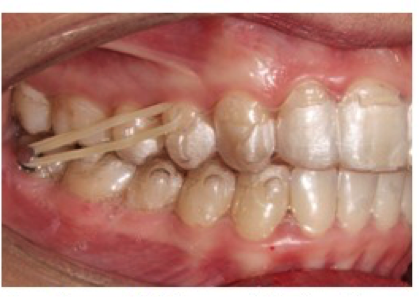 LOS ELASTICOS INTERMAXILARES – World's Hygienist