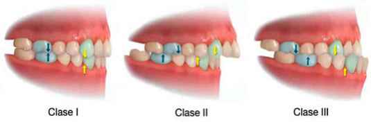 LOS ELASTICOS INTERMAXILARES – World's Hygienist